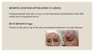corneal infection.pptx types causes management | PPTX