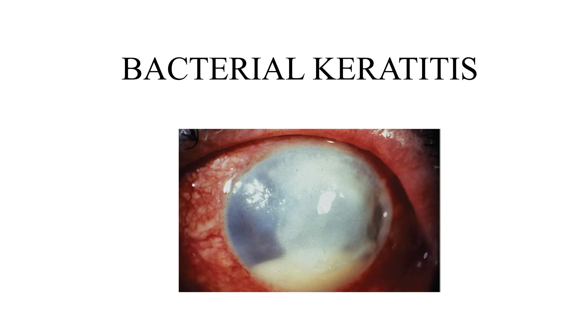 Corneal Keratitis- Infectious Keratitis and Mooren's Ulcer- Clinical ...