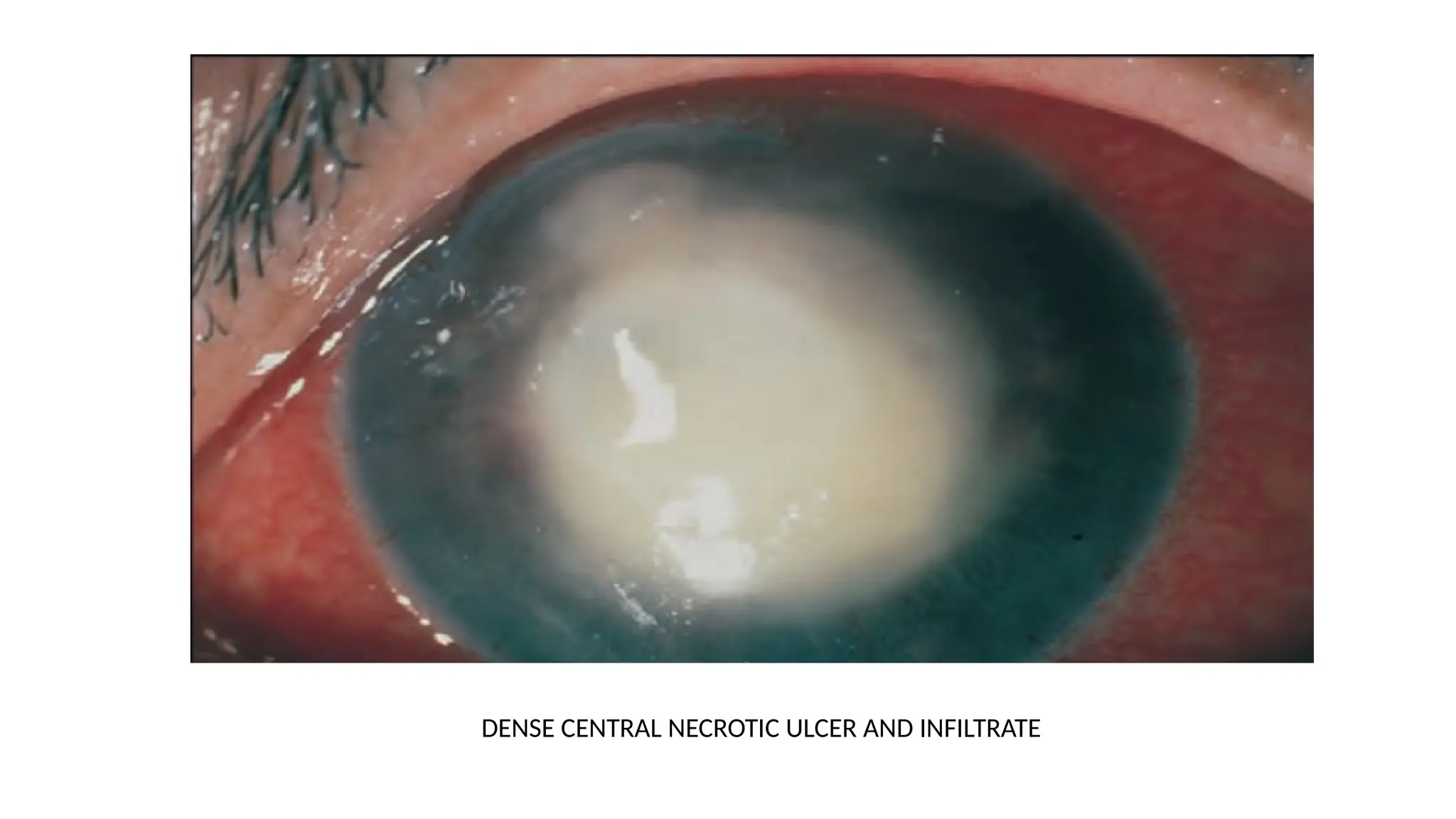 Corneal Keratitis- Infectious Keratitis and Mooren's Ulcer- Clinical ...