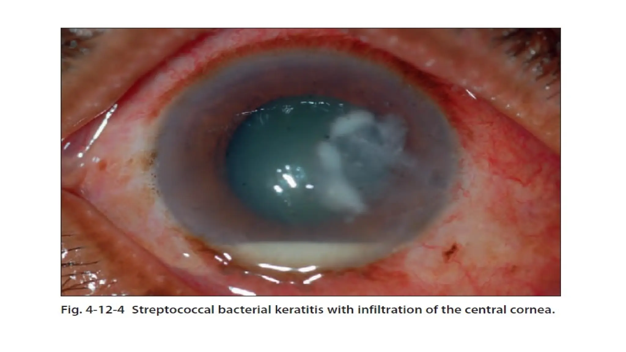 Corneal Keratitis- Infectious Keratitis and Mooren's Ulcer- Clinical ...