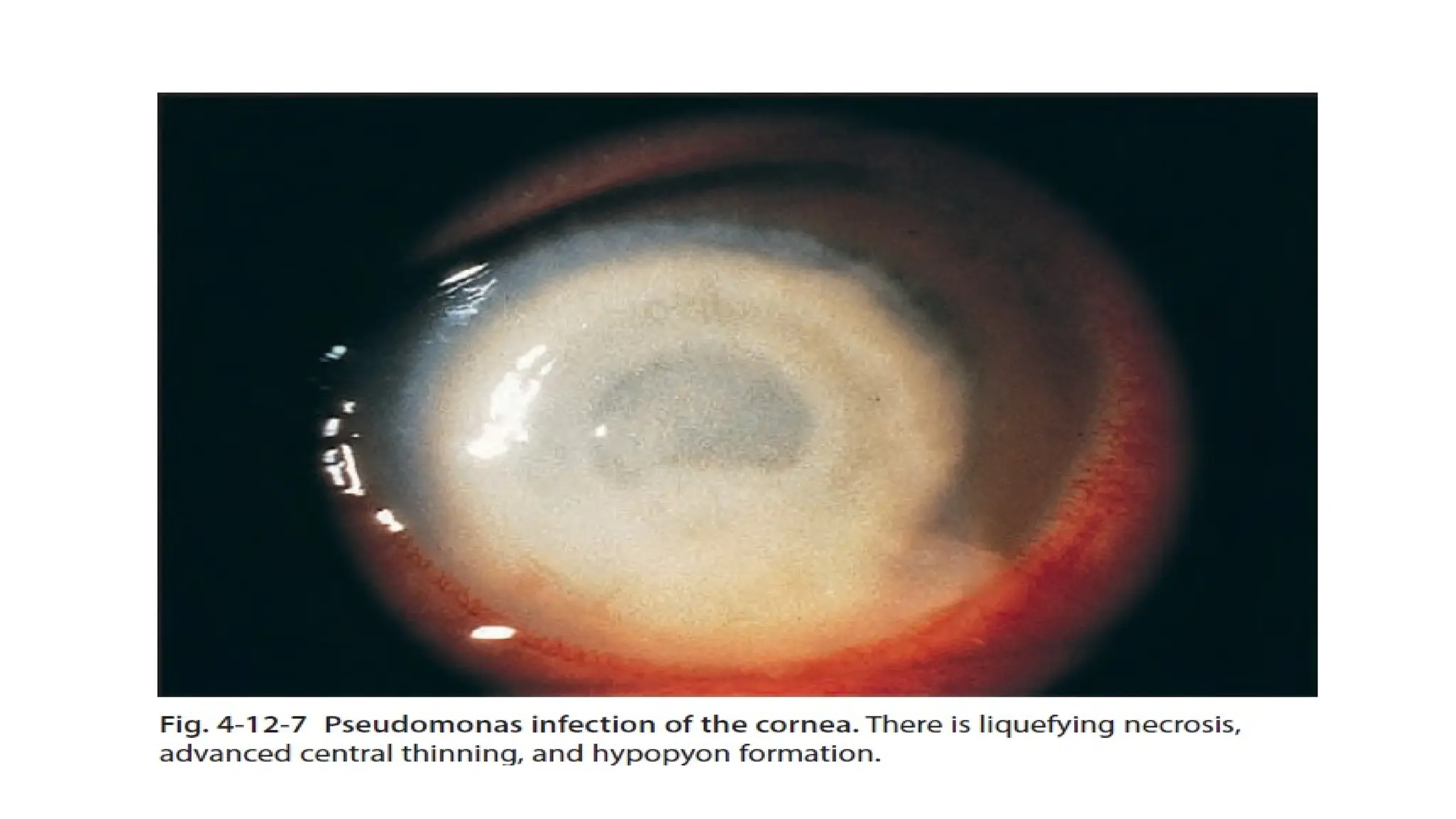 Corneal Keratitis- Infectious Keratitis and Mooren's Ulcer- Clinical ...