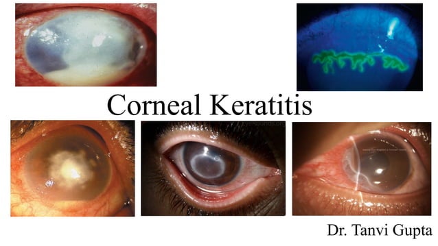 Corneal Keratitis- Infectious Keratitis and Mooren's Ulcer- Clinical Features, Complications and ...