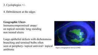Corneal Keratitis- Infectious Keratitis and Mooren's Ulcer- Clinical ...