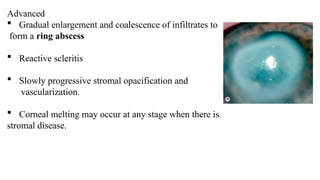 Corneal Keratitis- Infectious Keratitis and Mooren's Ulcer- Clinical ...