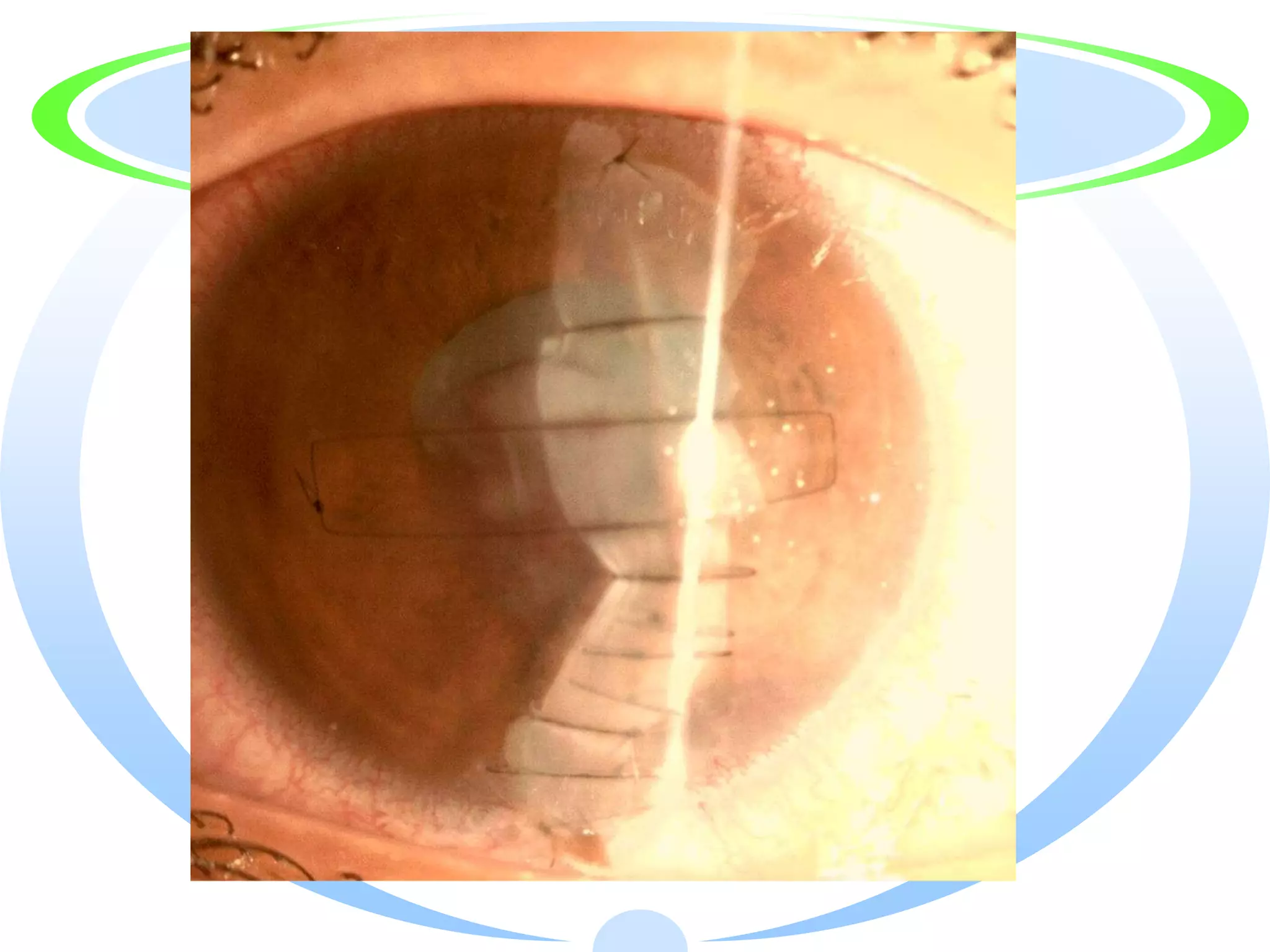 Corneal laceration repair tips | PPT