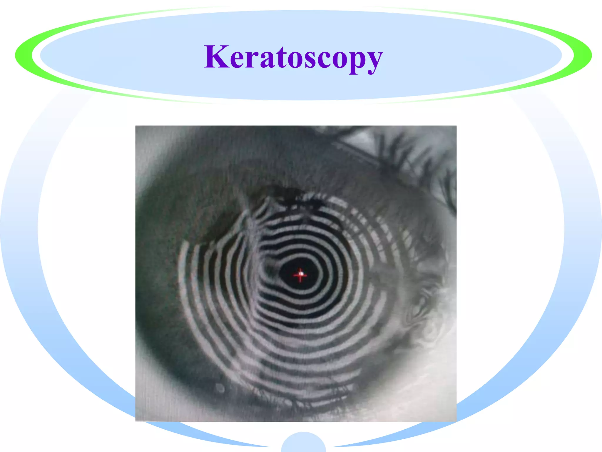 Corneal laceration repair tips | PPT