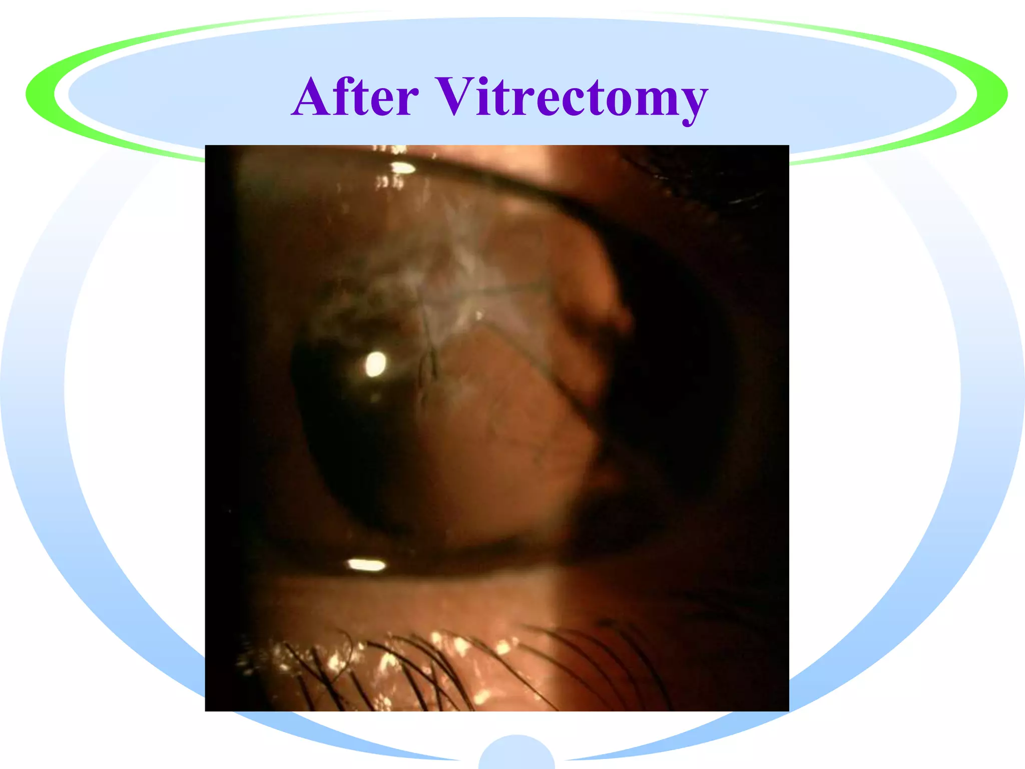 Corneal laceration repair tips | PPT