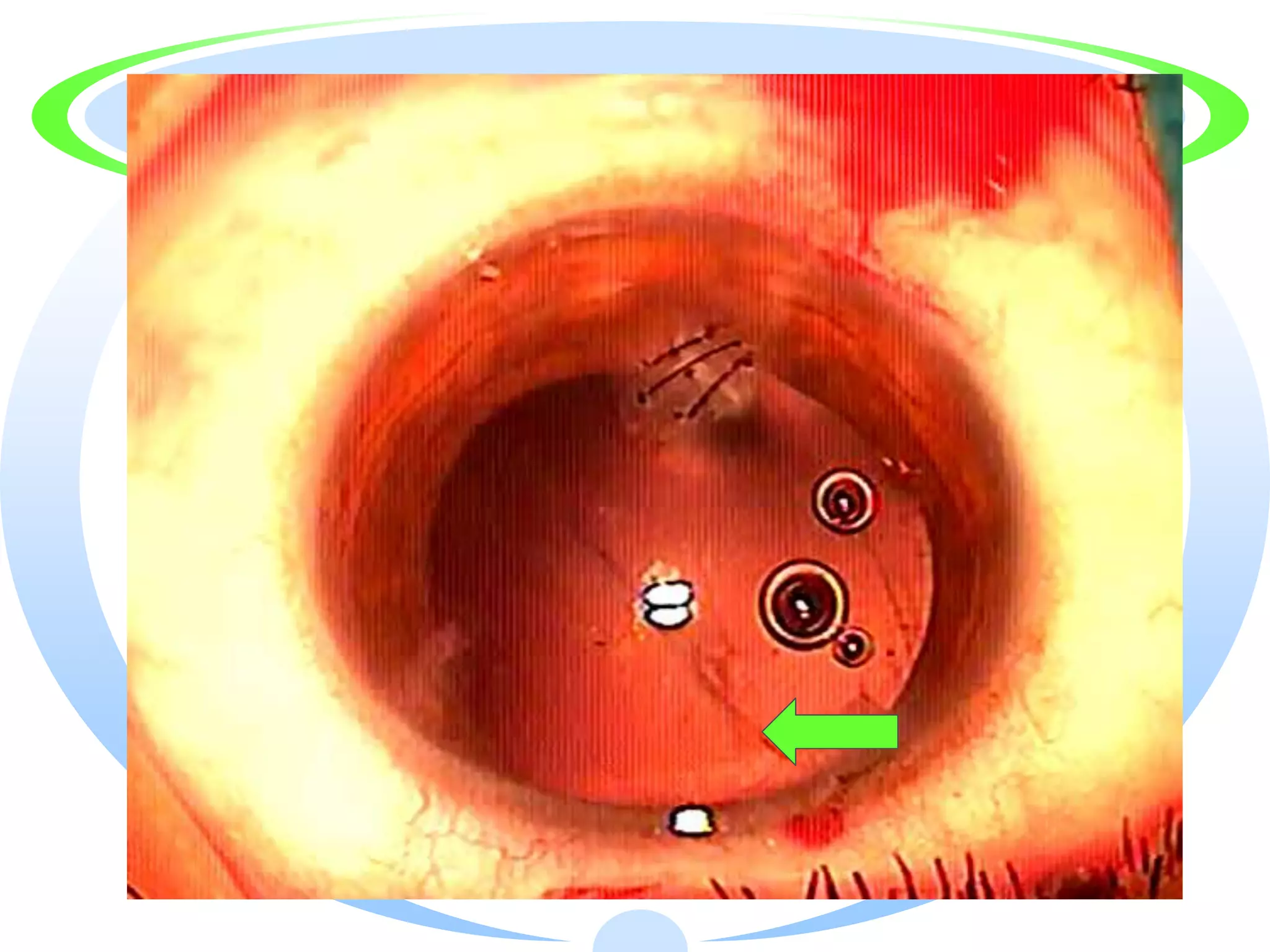 Corneal laceration repair tips | PPT