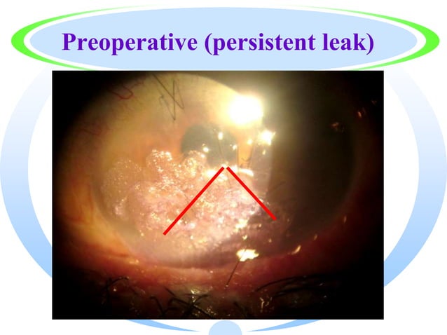 Corneal laceration repair tips | PPT | Eye and Vision Conditions ...