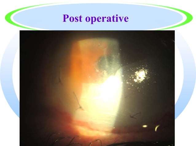 Corneal laceration repair tips | PPT | Eye and Vision Conditions ...