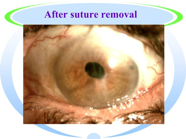 Corneal laceration repair tips | PPT | Eye and Vision Conditions ...