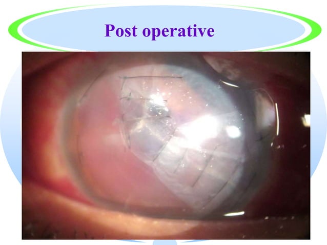 Corneal laceration repair tips | PPT | Eye and Vision Conditions ...