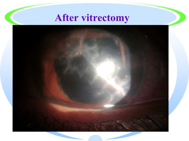 Corneal laceration repair tips | PPT | Eye and Vision Conditions ...