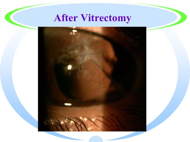 Corneal laceration repair tips | PPT | Eye and Vision Conditions ...