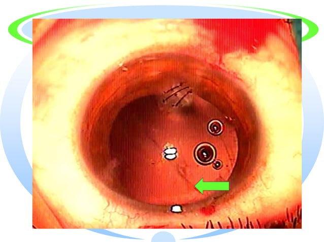 Corneal laceration repair tips | PPT | Eye and Vision Conditions ...