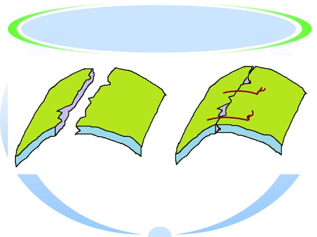 Corneal laceration repair tips | PPT | Eye and Vision Conditions ...