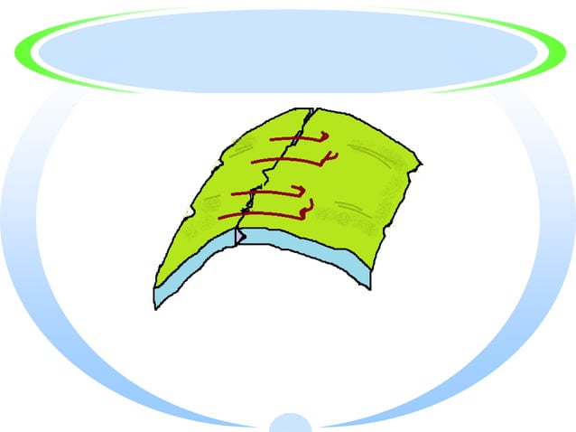 Corneal laceration repair tips | PPT | Eye and Vision Conditions ...