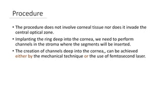Corneal laser surgery | PPT
