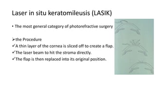 Corneal laser surgery | PPT