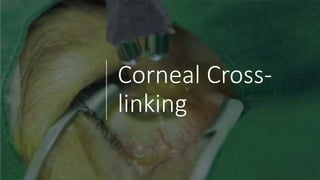 Corneal laser surgery | PPTX