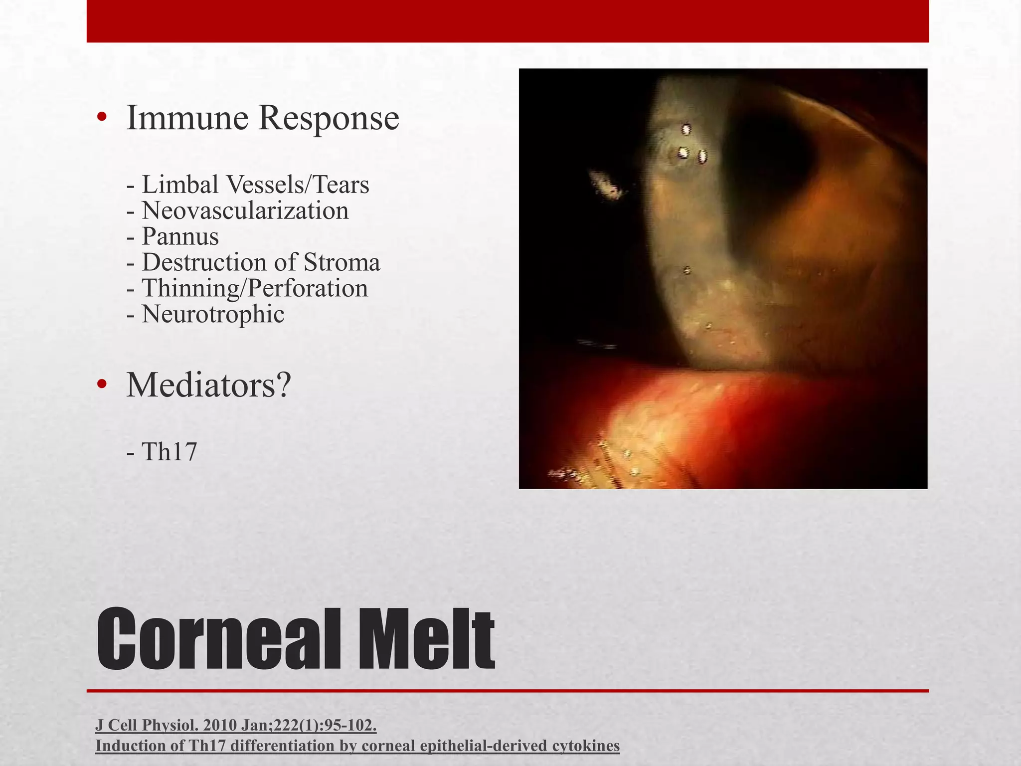 Corneal Melt | PPTX