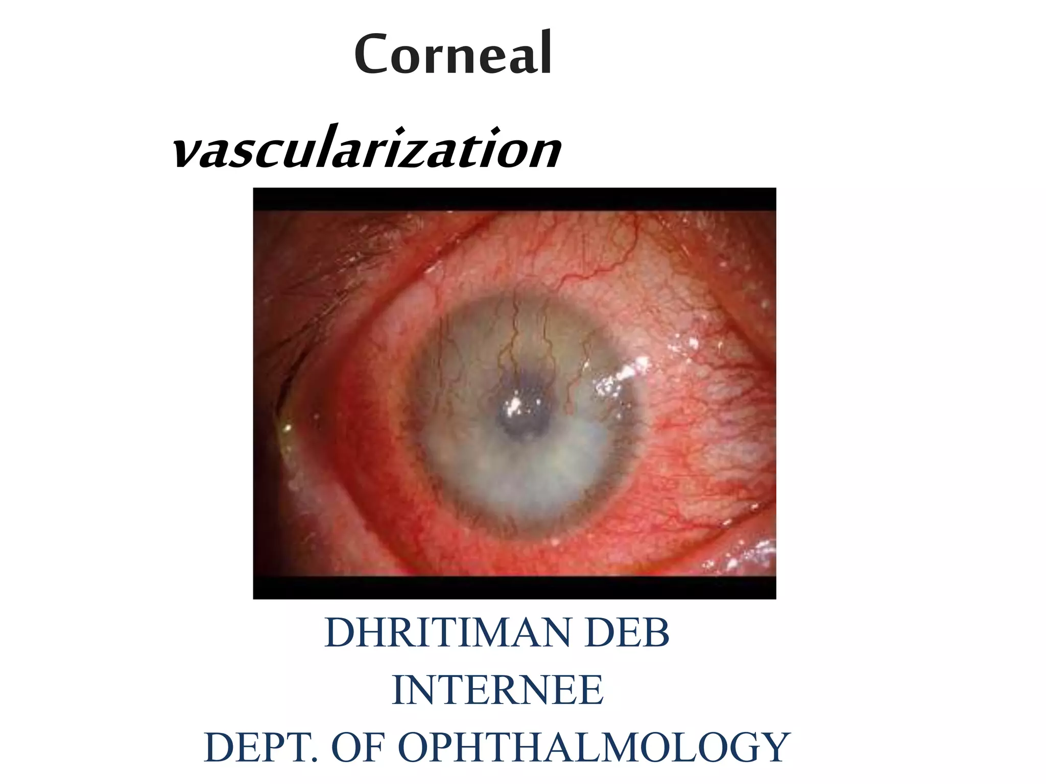 Corneal neovascularization | PPTX
