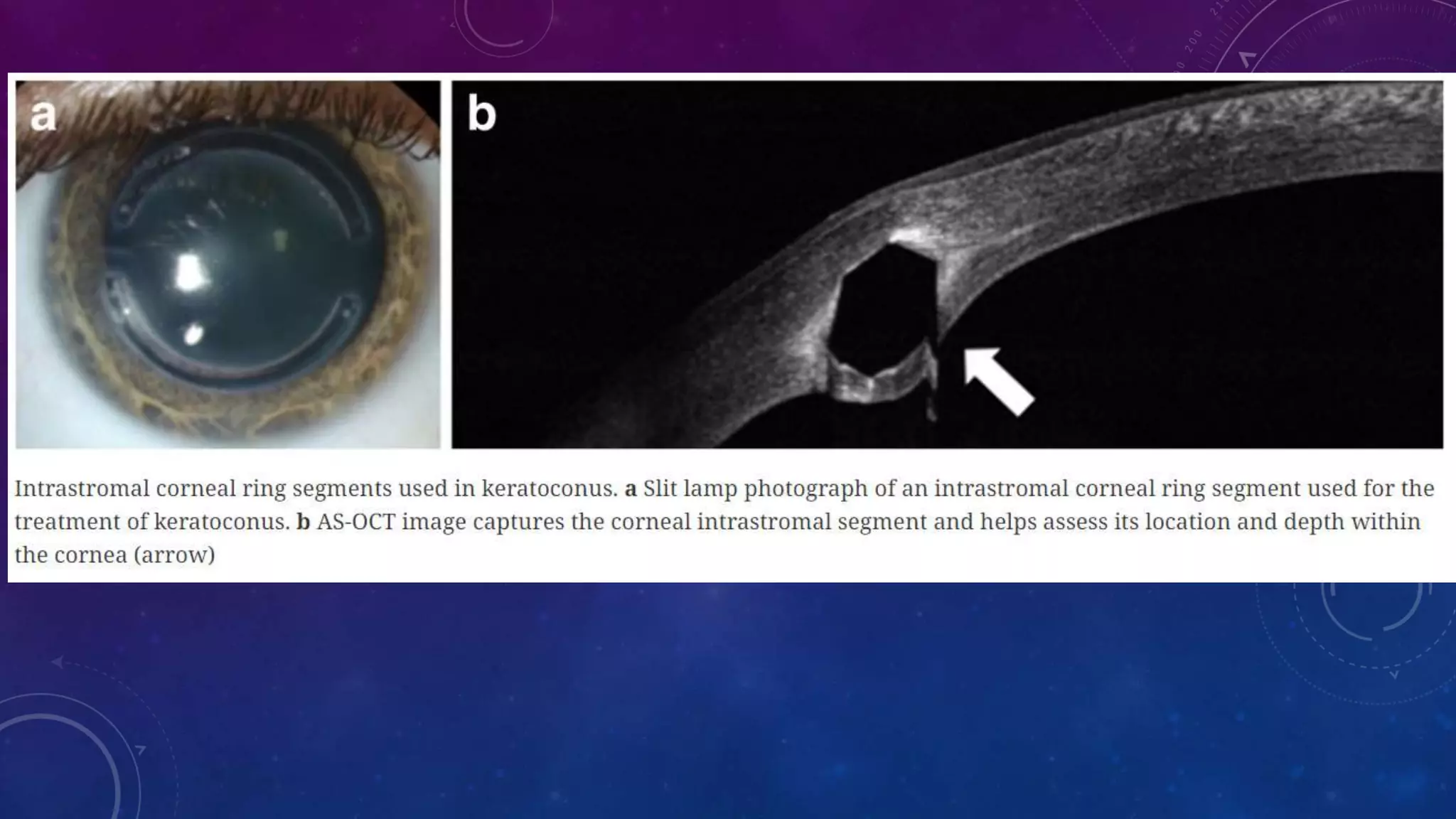 Anterior segment and Corneal OCT review | PPSX