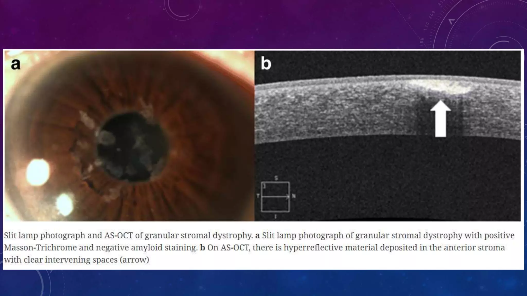 Anterior segment and Corneal OCT review | PPSX