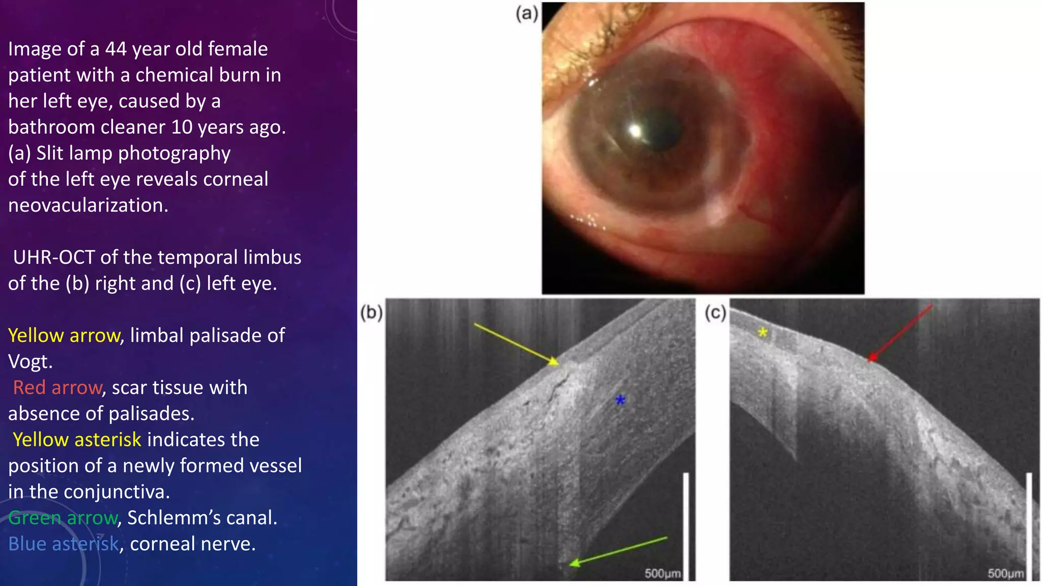 Anterior segment and Corneal OCT review | PPSX