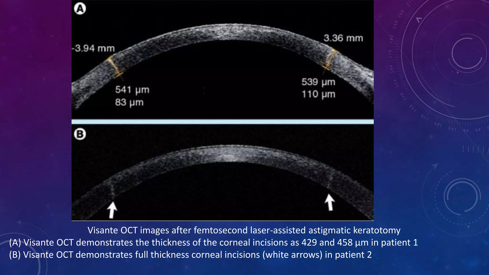 Anterior segment and Corneal OCT review | PPSX