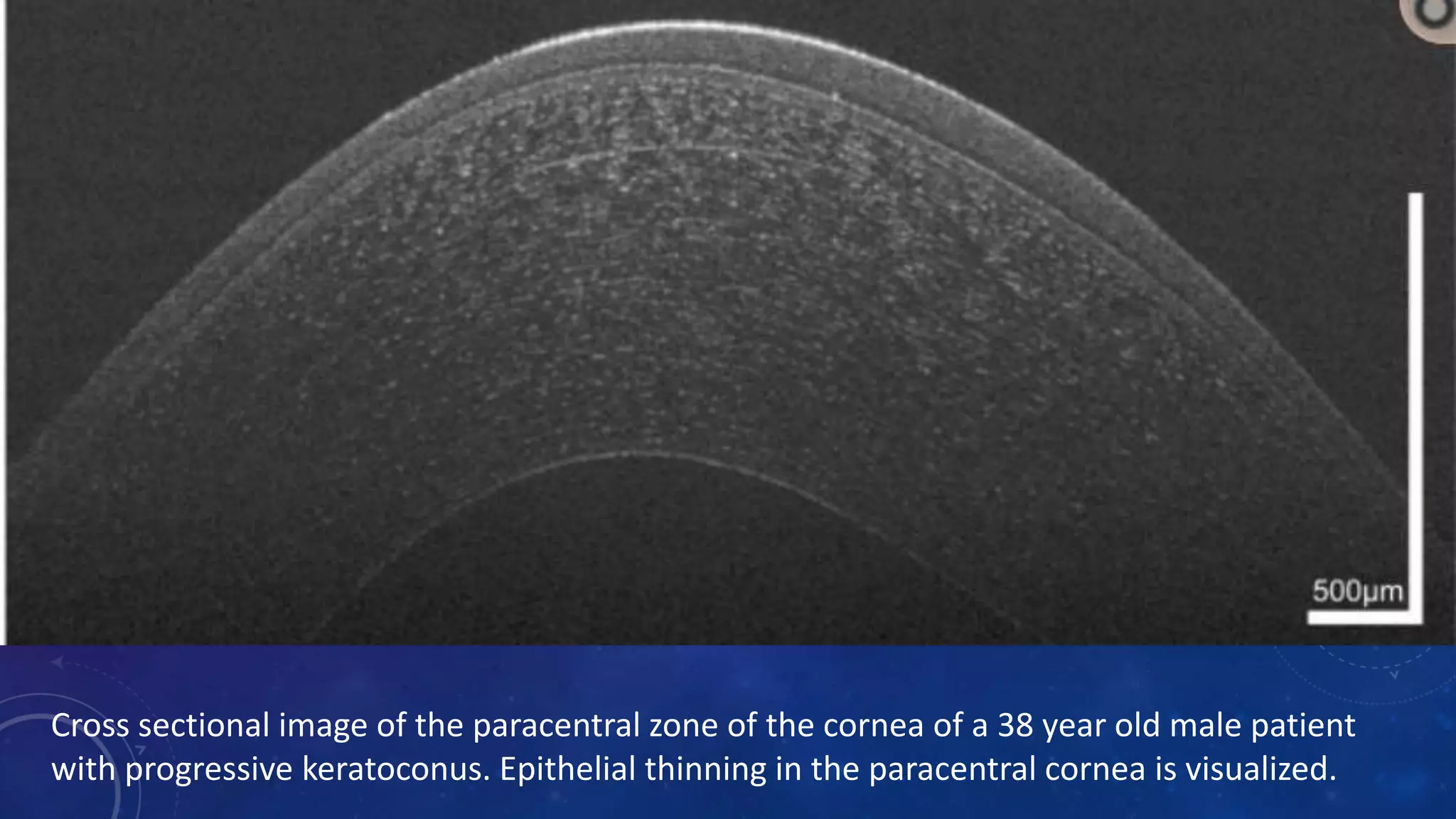 Anterior segment and Corneal OCT review | PPSX