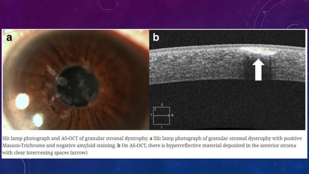 Anterior segment and Corneal OCT review | PPSX