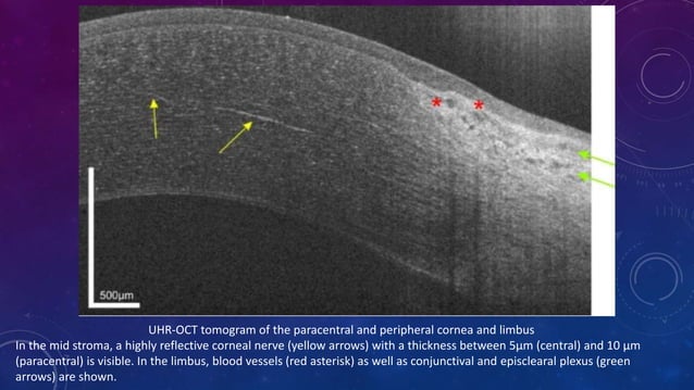 Anterior segment and Corneal OCT review | PPSX