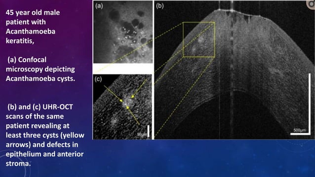 Anterior segment and Corneal OCT review | PPSX