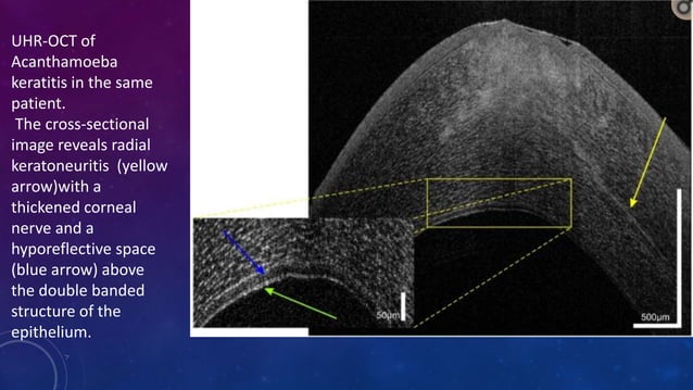 Anterior segment and Corneal OCT review | PPSX