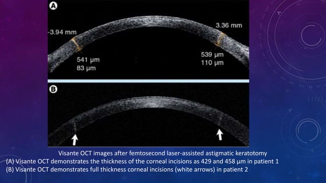 Anterior segment and Corneal OCT review | PPSX