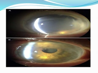 corneal opacities CORNEA transparency | PPTX