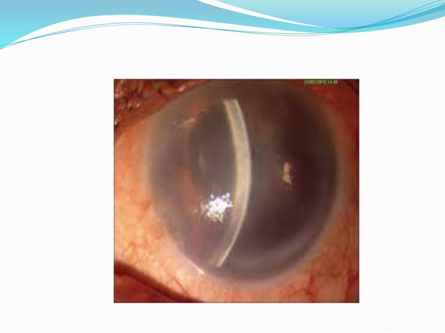 corneal opacities CORNEA transparency | PPTX