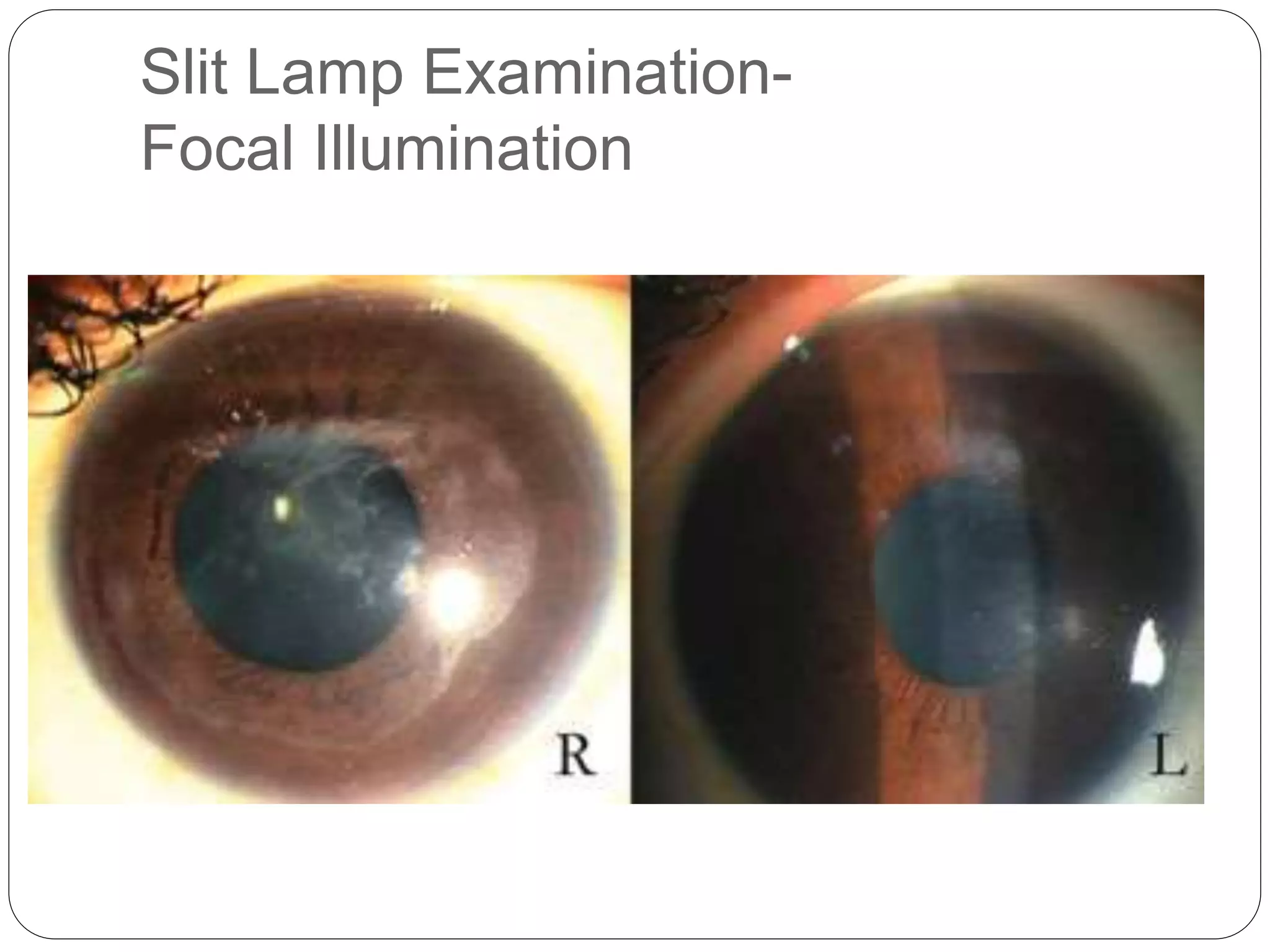 Corneal Opacity | PPTX