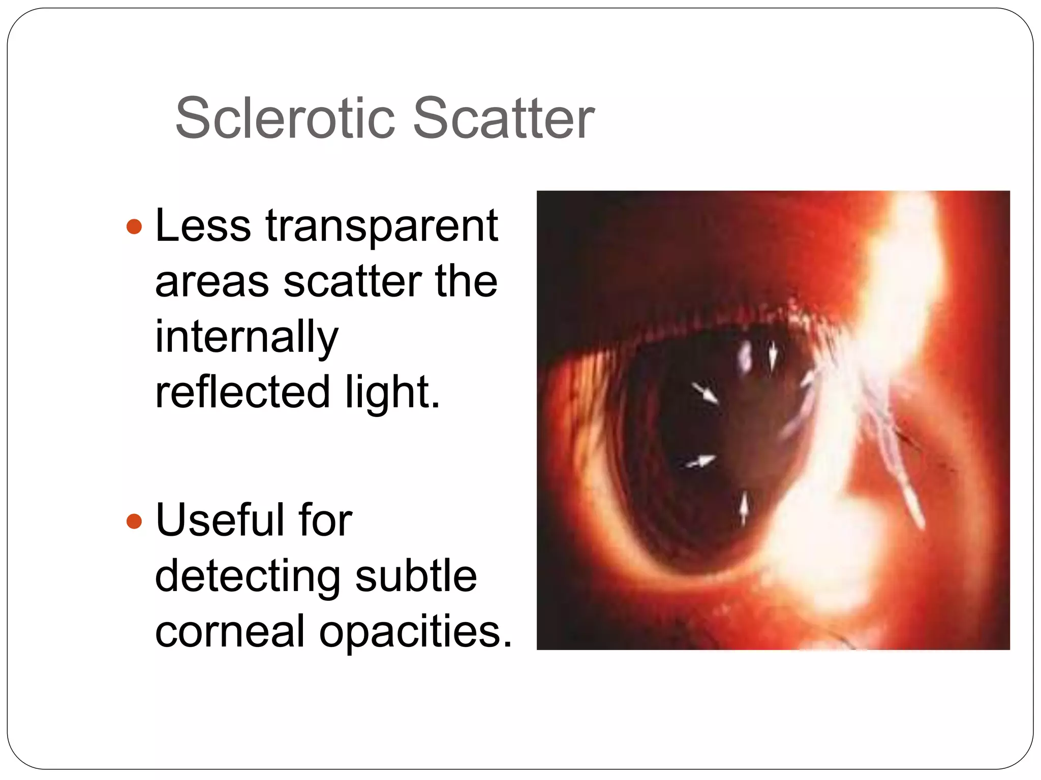 Corneal Opacity | PPTX