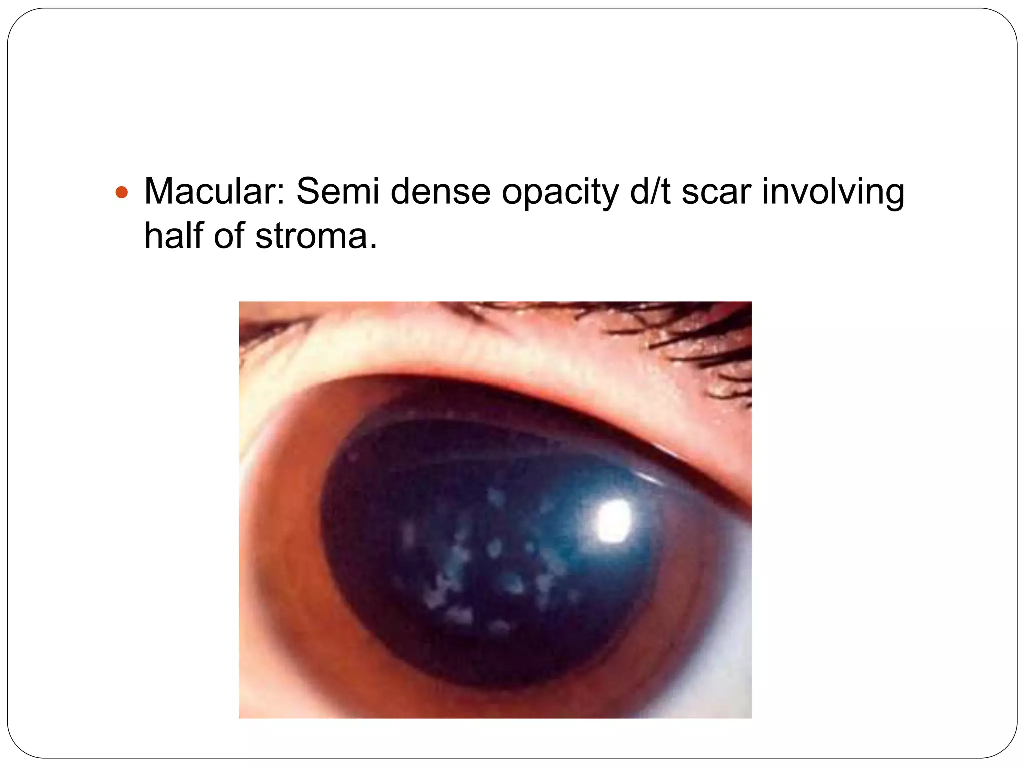 Corneal Opacity | PPTX