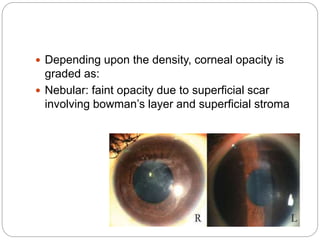 Corneal Opacity | PPTX