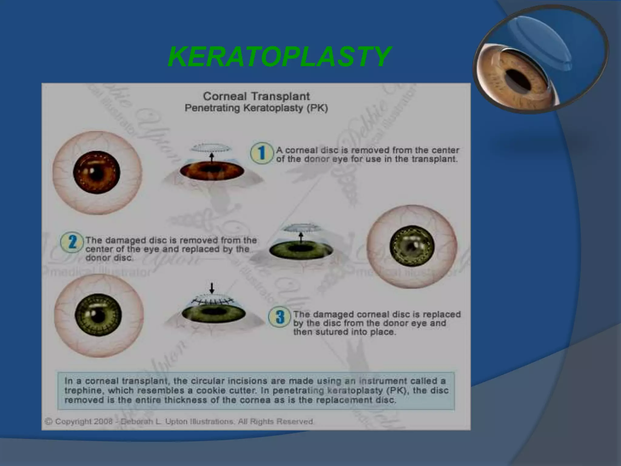 Corneal opacity | PPTX