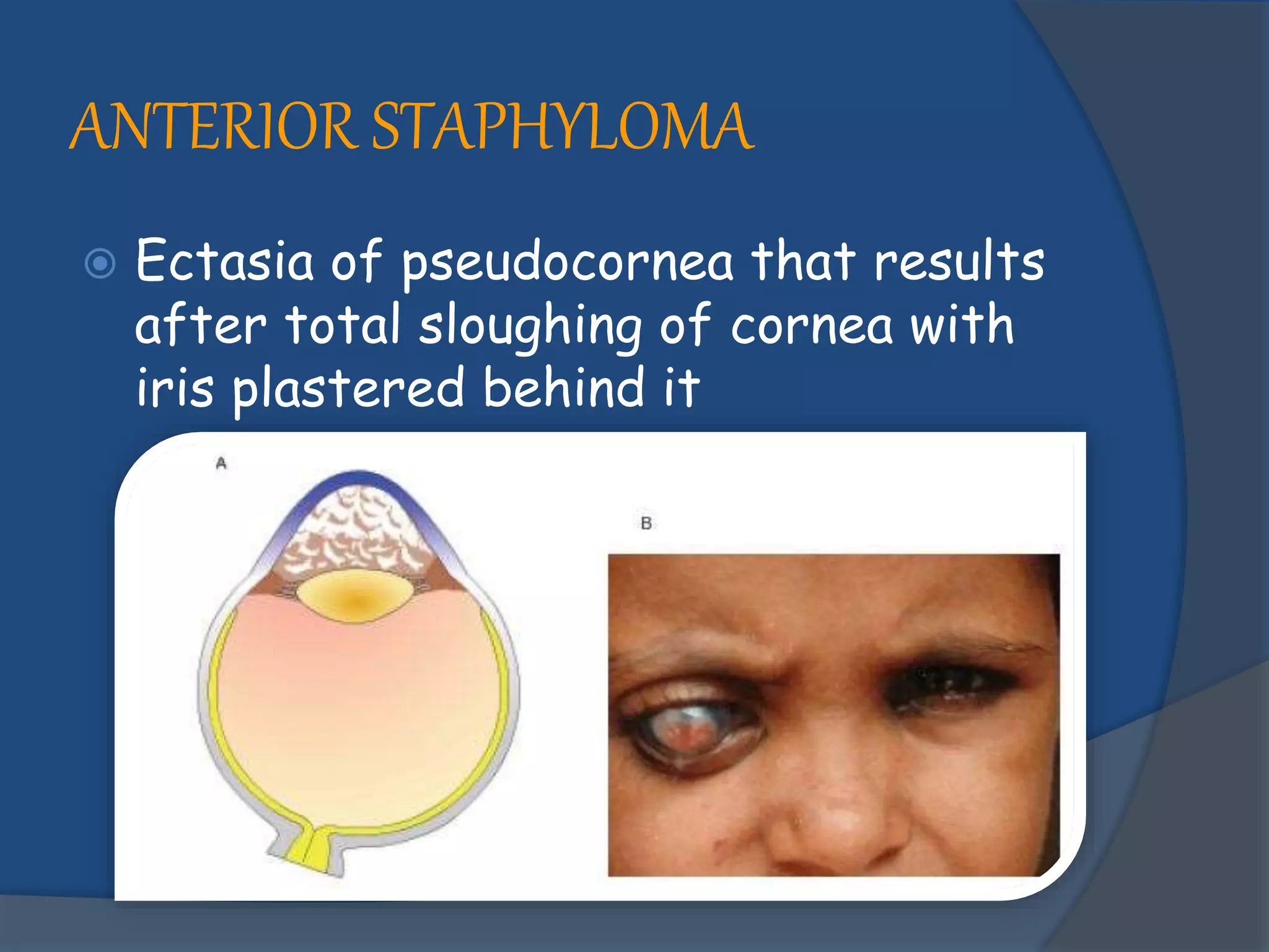 Corneal opacity | PPTX