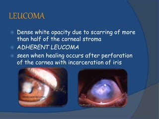 Corneal opacity | PPTX