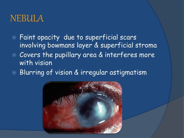 Corneal opacity | PPT