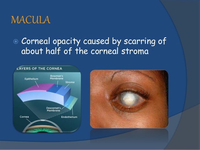 Corneal opacity