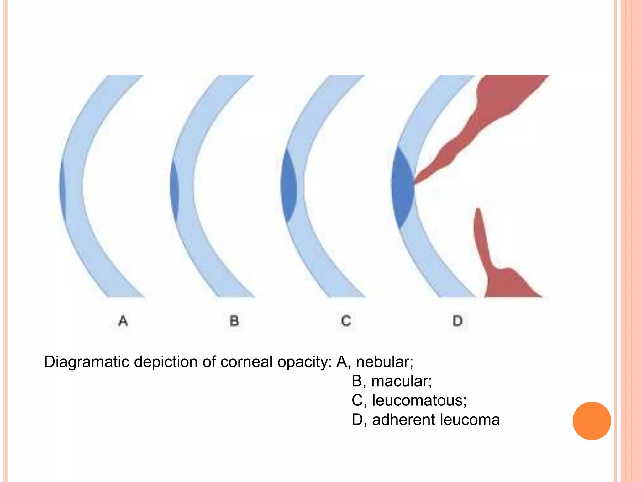 Corneal opacity | PPTX
