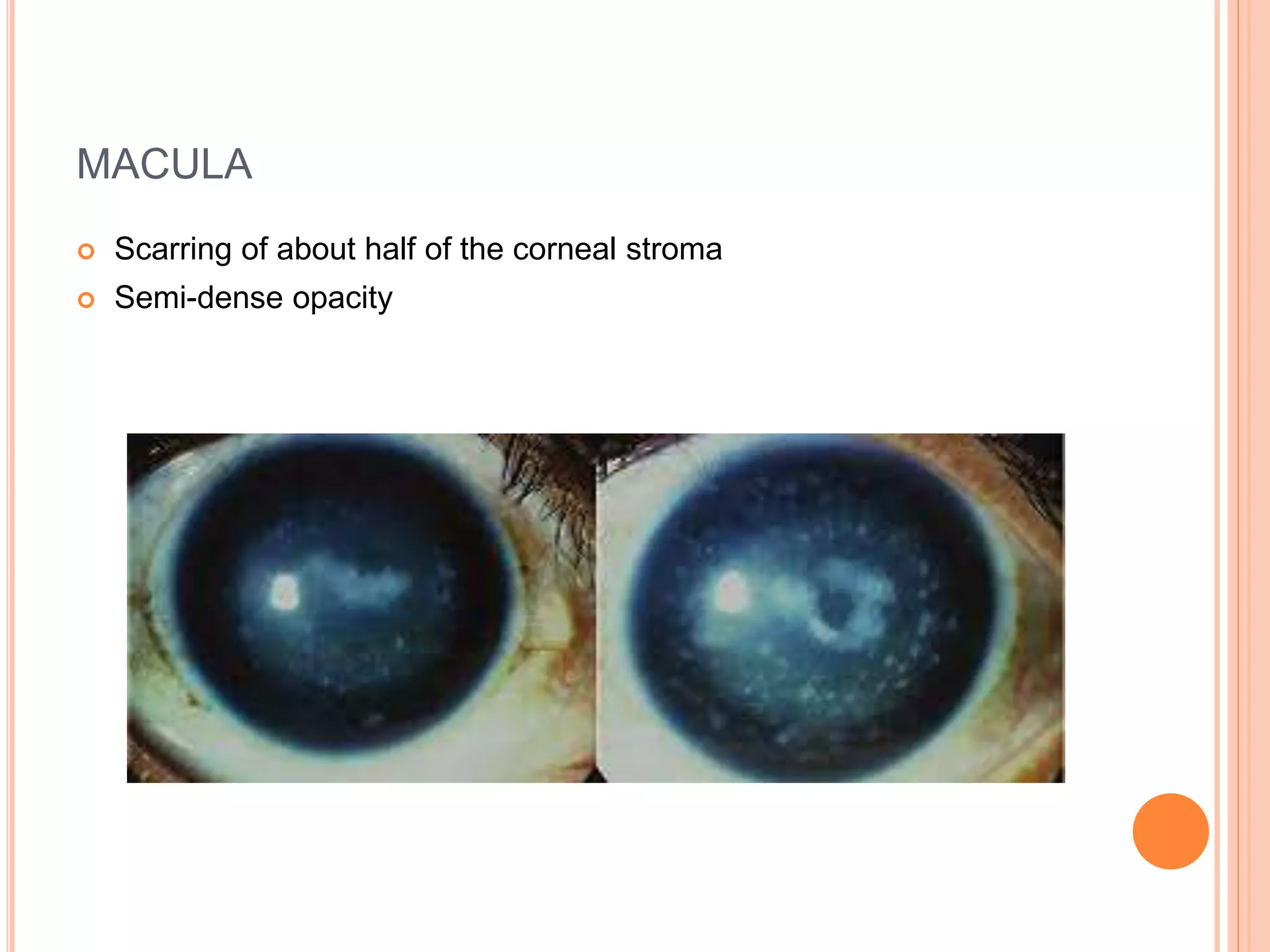 Corneal opacity | PPTX