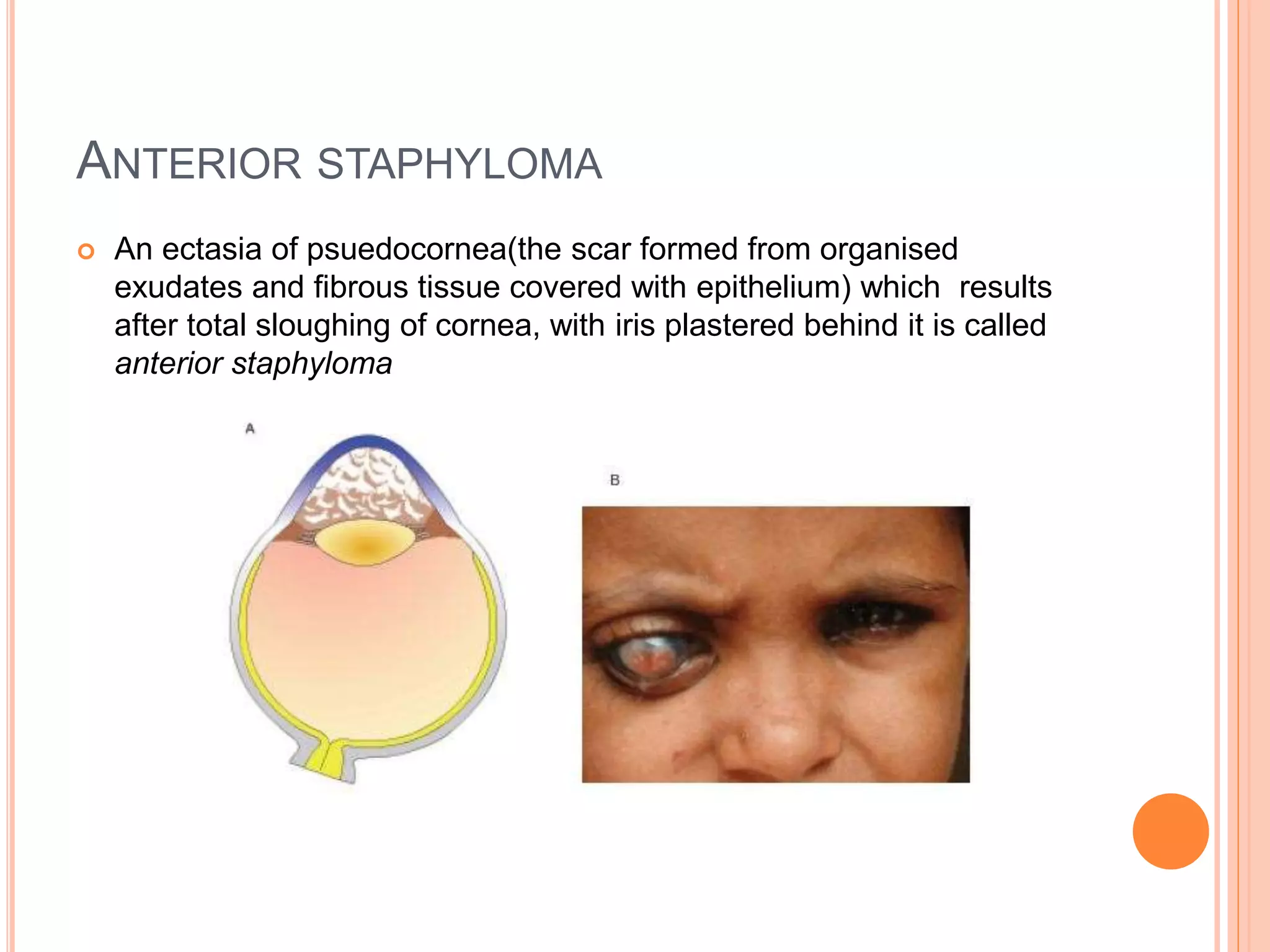 Corneal opacity | PPTX